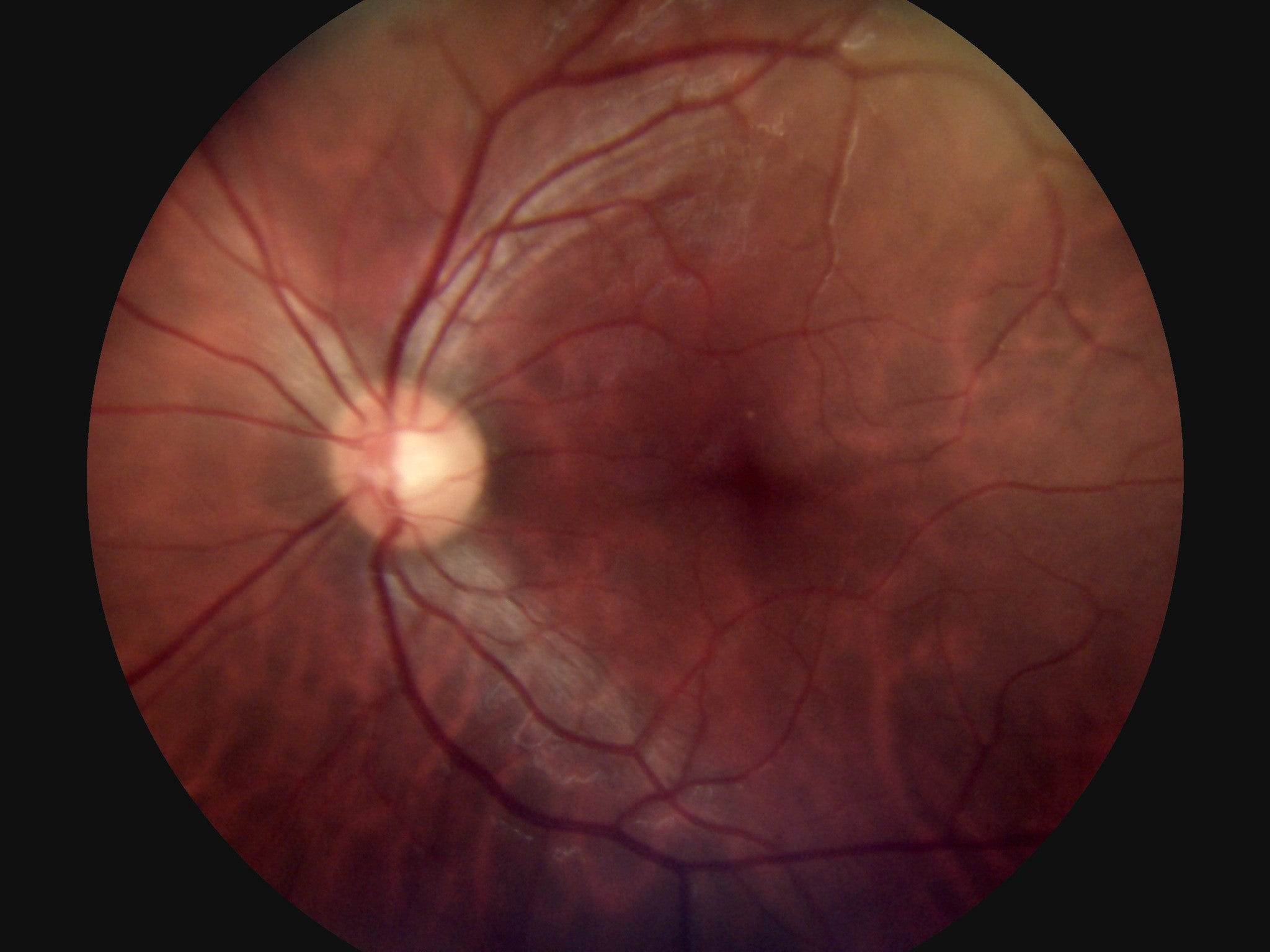 Portable Fundus Camera - JEDMED